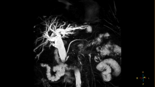 Colangioresonancia | La prueba DEFINITIVA