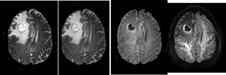 Difusión en Resonancia Magnética: Avances y Aplicaciones